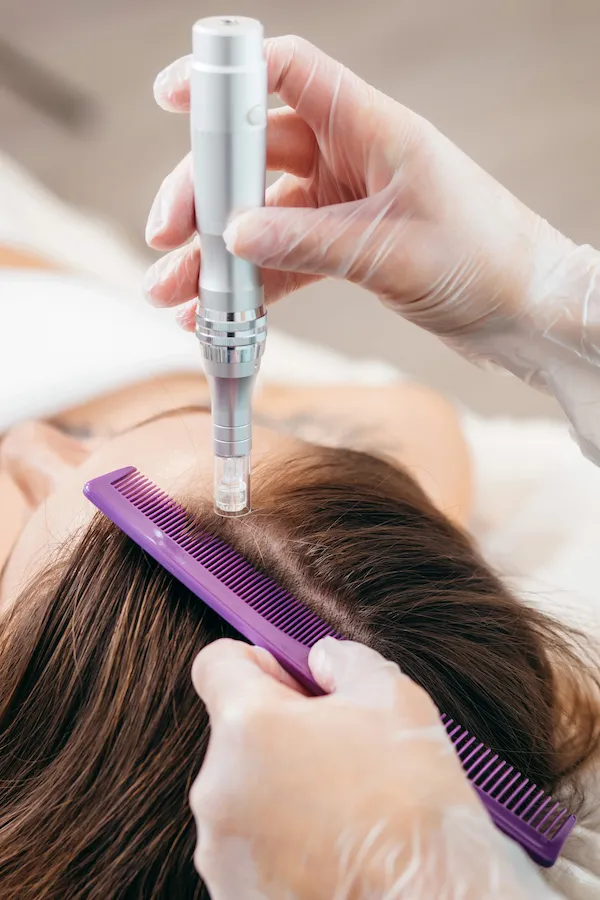 Microagulhamento Capilar | Clínica Carol Lima